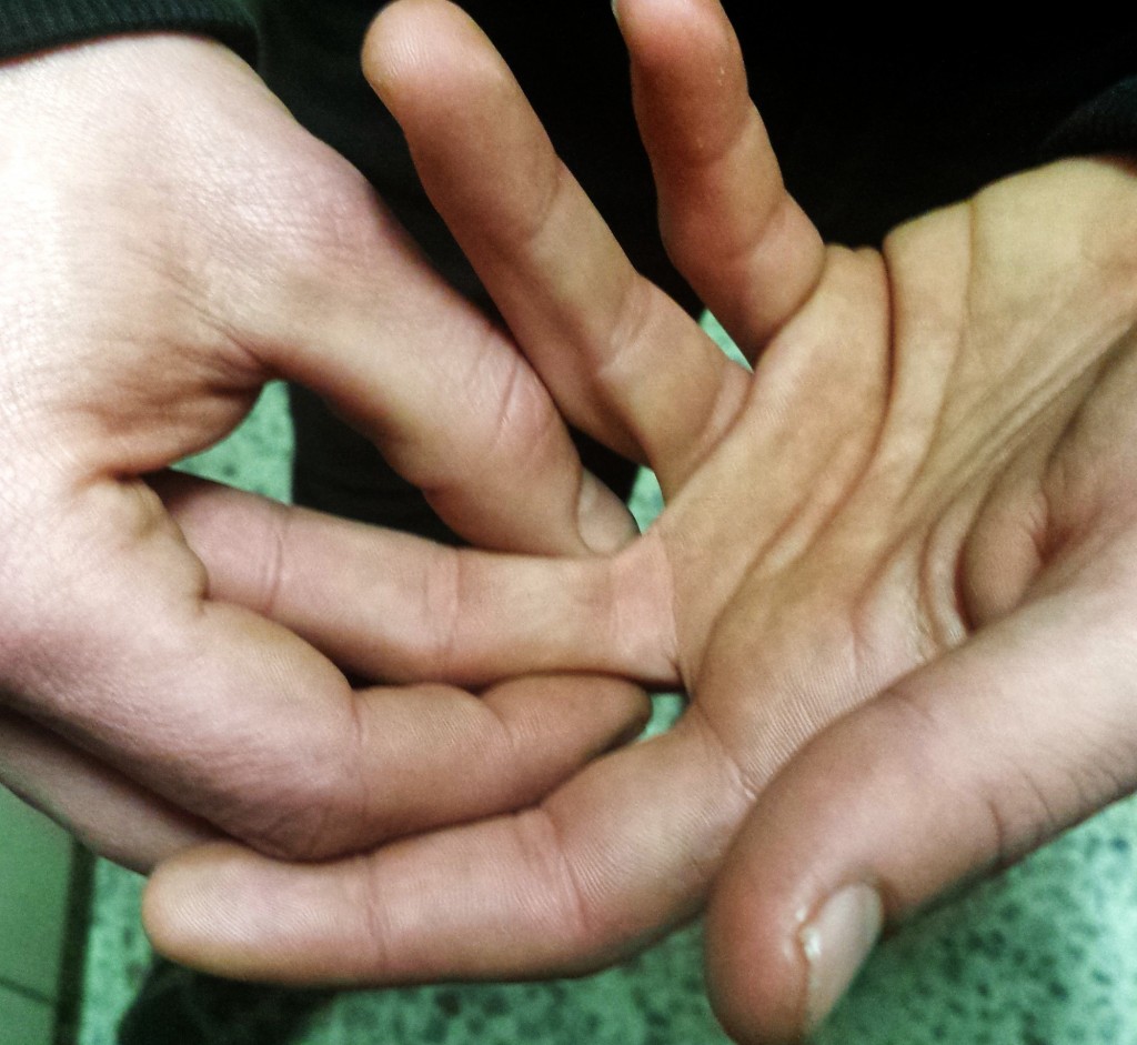 Patologías típicas de mano Archivos - Hand Therapy BCN